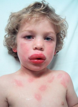 Anaphylaxis and Food Allergies at Christmas | Sea to Sky First Aid Training